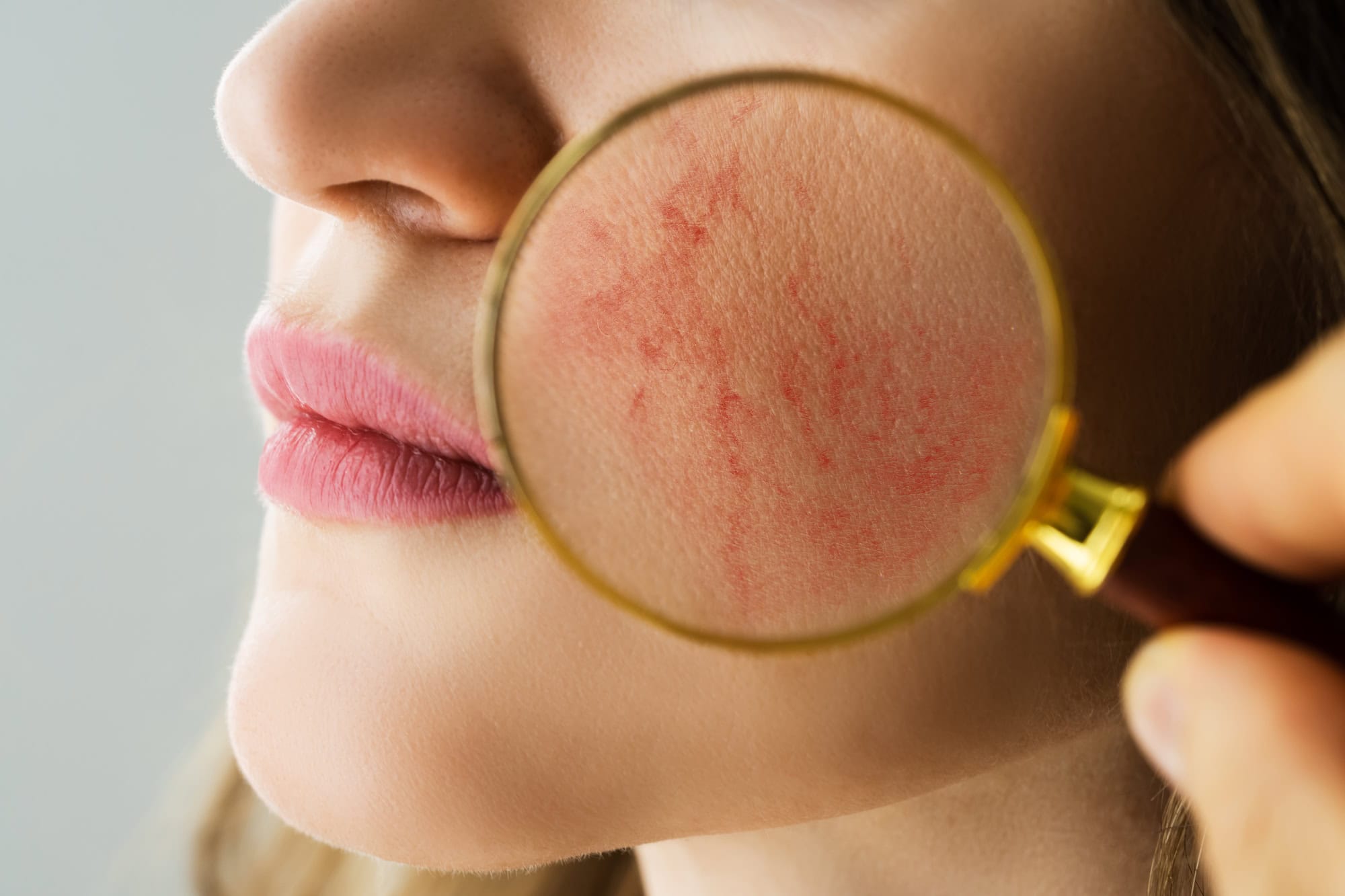 What type of Skin Care is good for Rosacea? - Glow Medispa