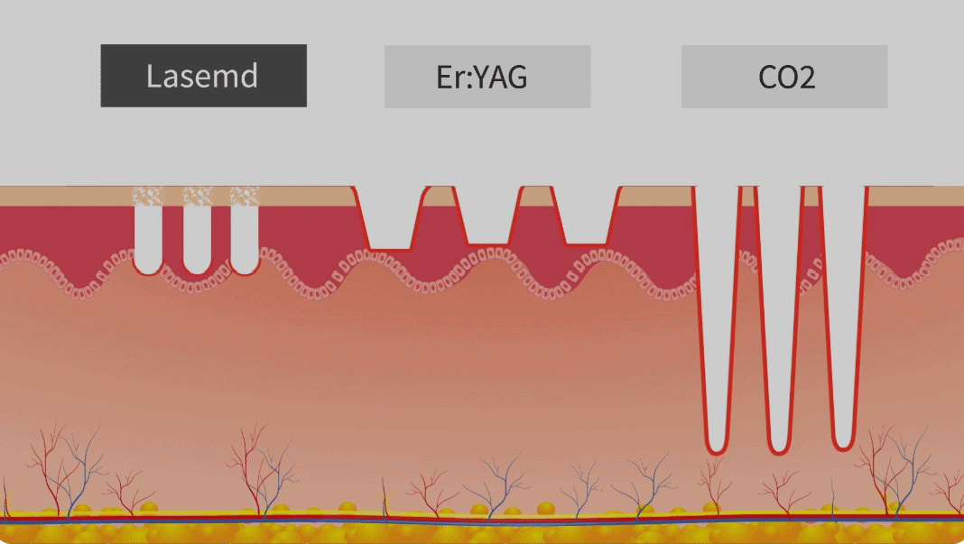What is Skin Resurfacing? | Glow Medispa Seattle